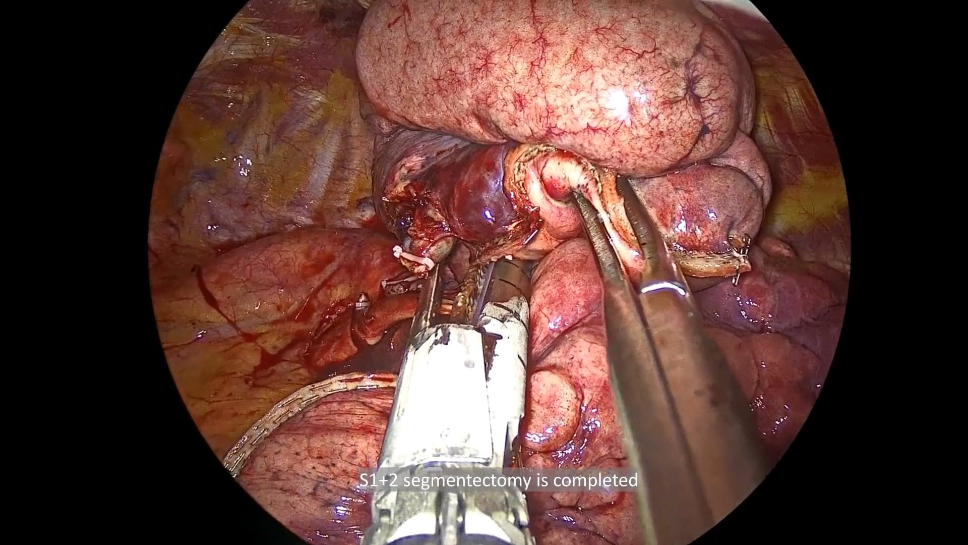 Uniportal video-assisted thoracoscopic surgery left upper lobe ...
