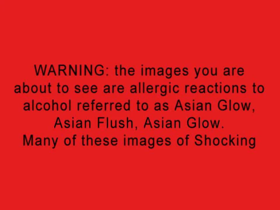 -SHOCKING IMAGES red face from alcohol allergic reaction on Vimeo