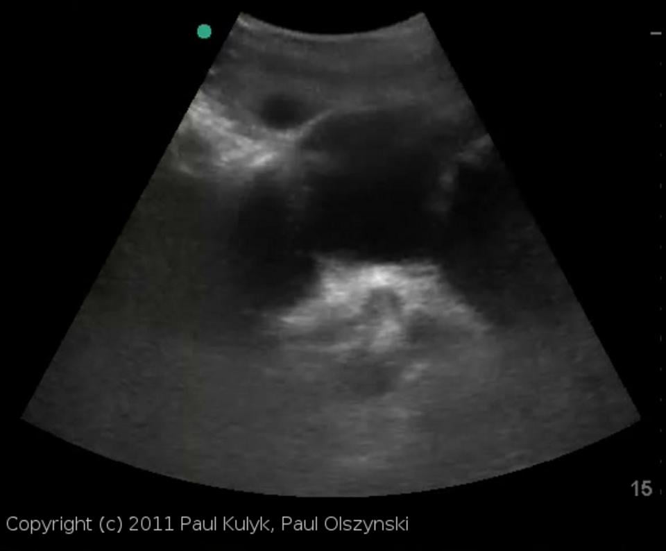 EDUS: FAST, Pelvis, Positive Free Fluid on Vimeo