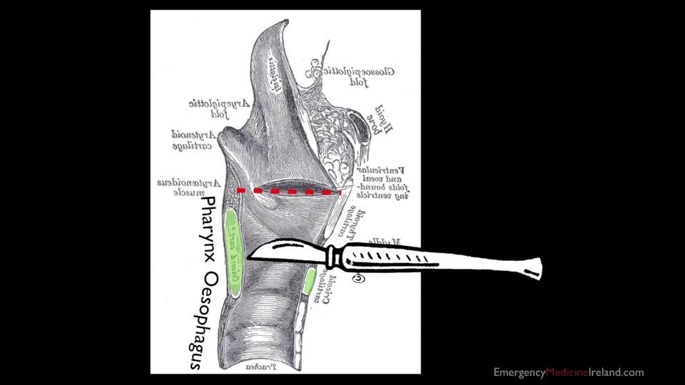 Anatomy for Emergency Medicine 07: Cricothyroidotomy on Vimeo
