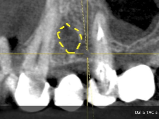 Impianto su cisti residua – Studio dentistico Mora Legnago (Verona ... Impianto su cisti residua – Studio dentistico Mora Legnago (Verona ...