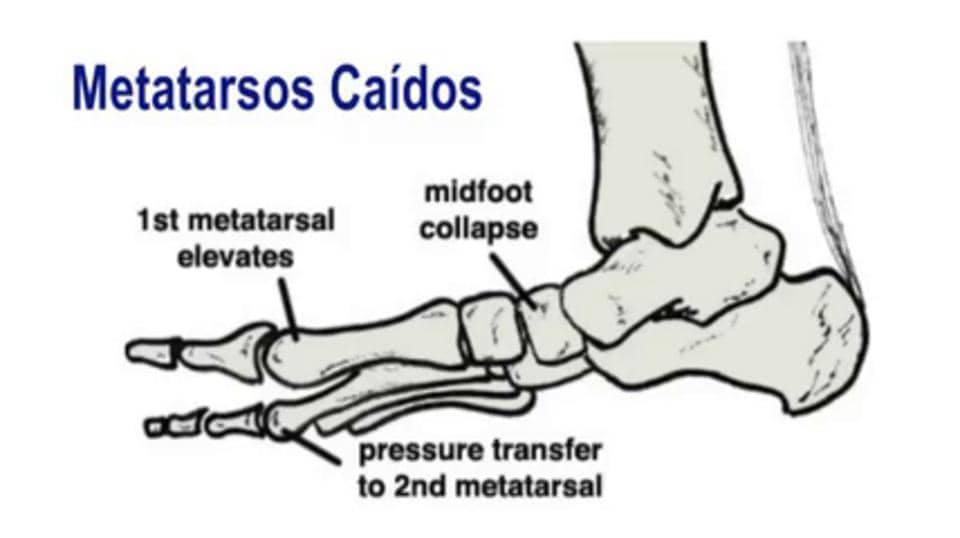 Metatarsos Caídos (Dolor en la Planta del Pie) - Podólogo en NYC ...