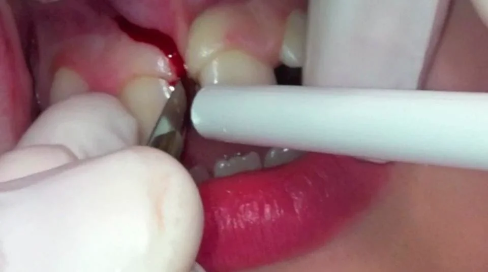 Freinectomie labiale supérieure