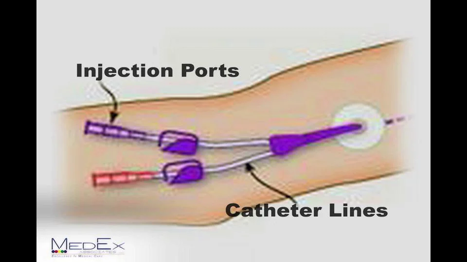 IV Antibiotics - What is a PICC Line? on Vimeo