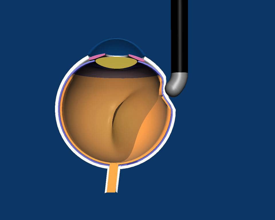 CRYODE (CRYOAPPLICATION TRANS-SCLERALE) on Vimeo