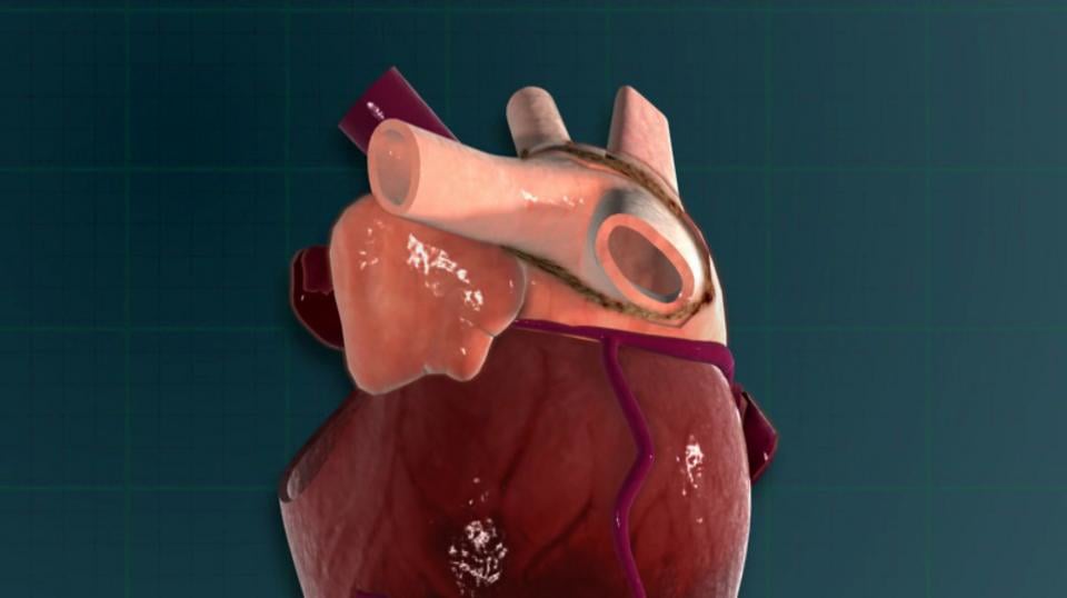 Atrial Fibrillation (AF | AFib) Animation - Scientific Animations | 3D Cardiology Animation on Vimeo