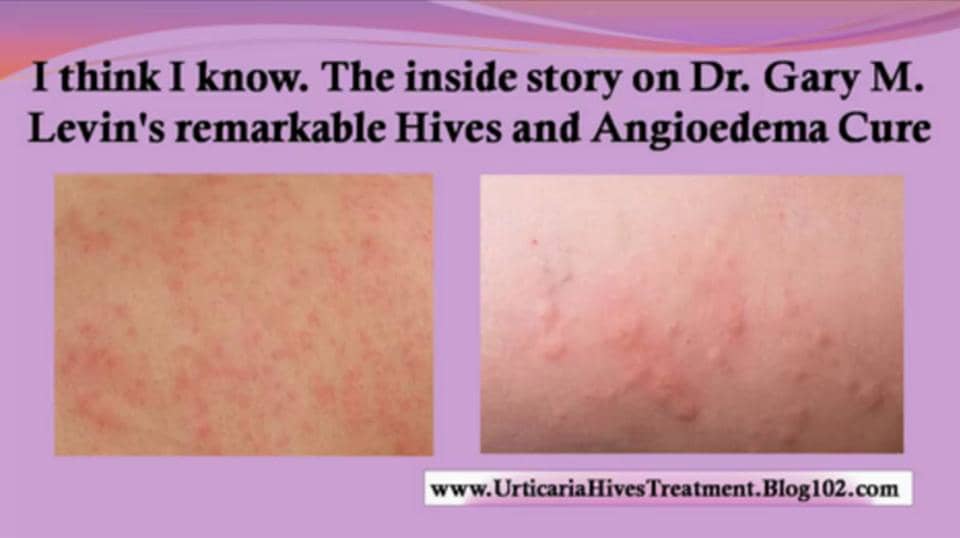 urticaria pigmentosa - urticaria treatment - papular urticaria on Vimeo