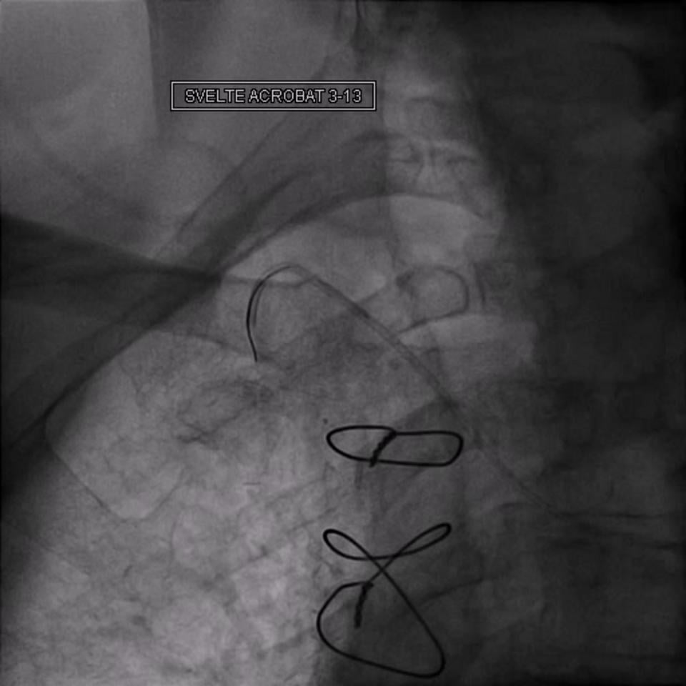 Cassagneau RIMA Bypass Graft Stenting VidB on Vimeo