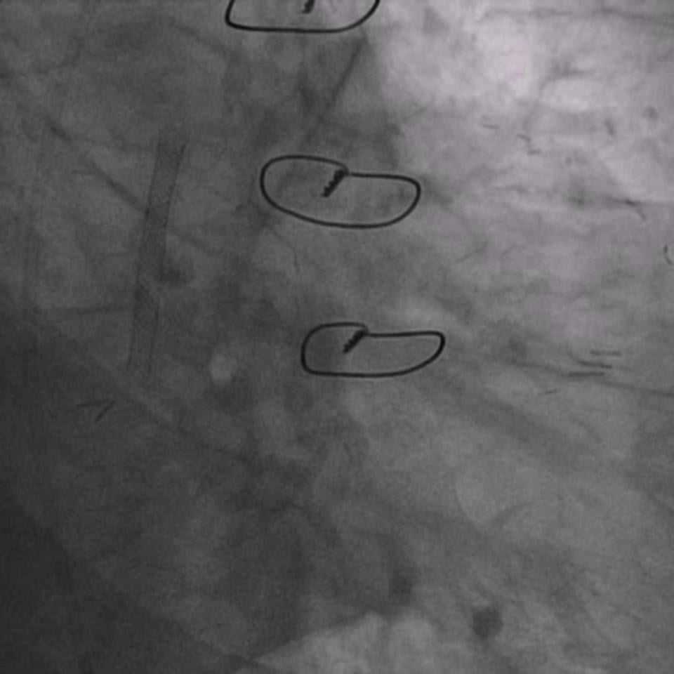 Cassagneau RIMA Bypass Graft Stenting VidF on Vimeo
