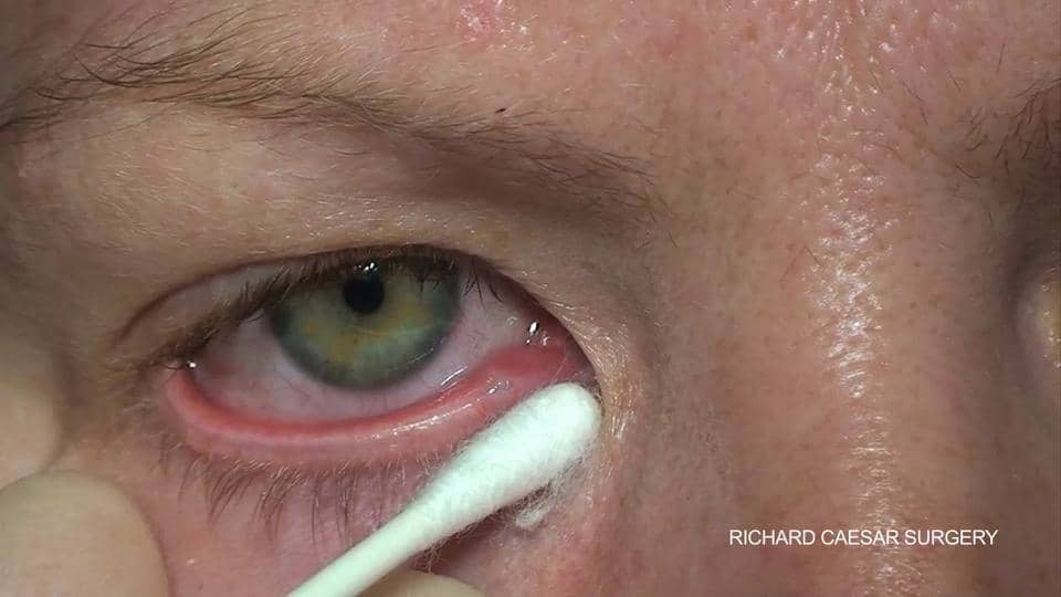 Incision and Curettage of Canaliculitis on Vimeo