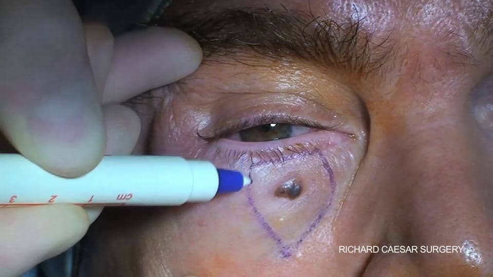 Flap and Wedge Repair on Vimeo