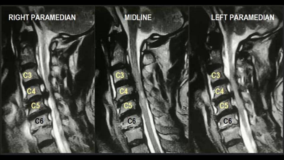 C3-C6 Discectomies, C4-C5 Corpectomies & C3-C6 Strut Grafting for ...