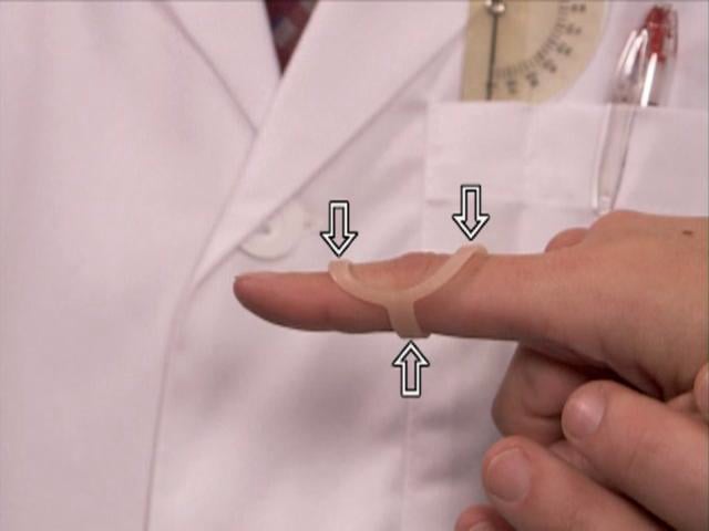 Oval-8 splints on Vimeo