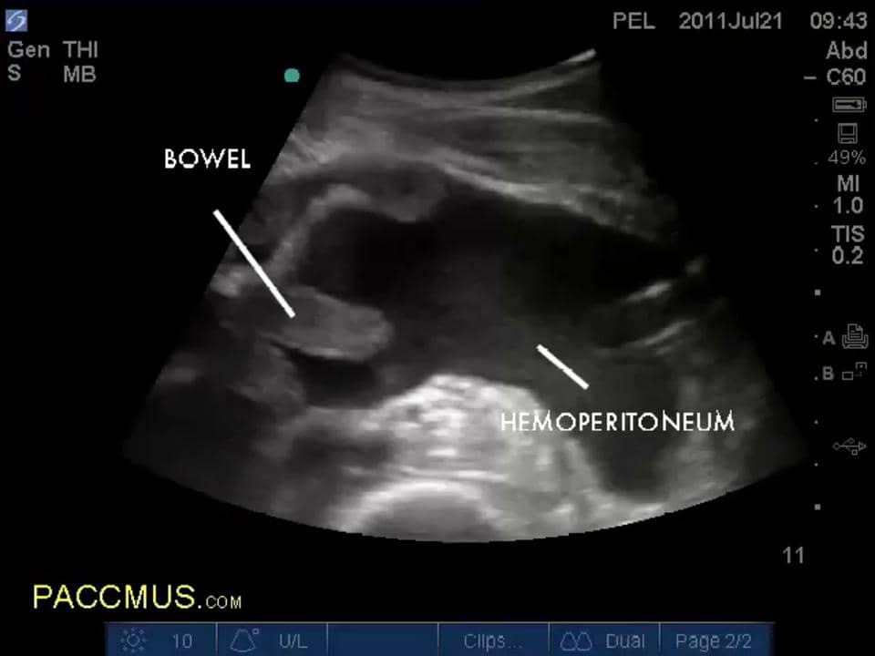 US Clip Hemoperitoneum on Vimeo
