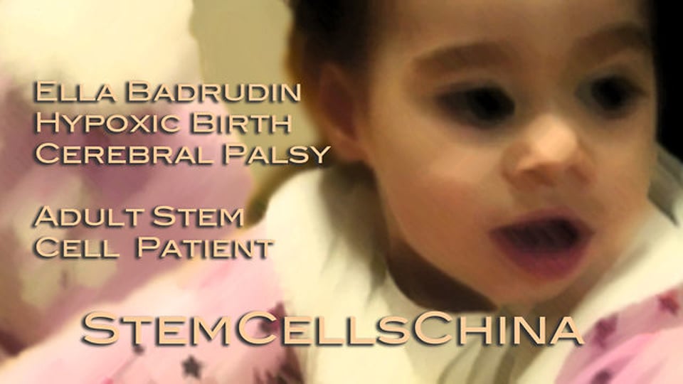 Ella Badrudin - Adult Stem Cell Patient for CP - Beike Cell Therapy