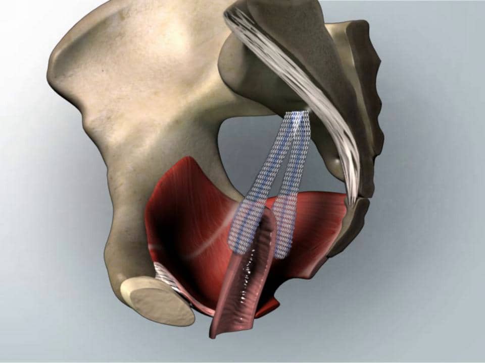Sacrocolpopexy Surgery on Vimeo