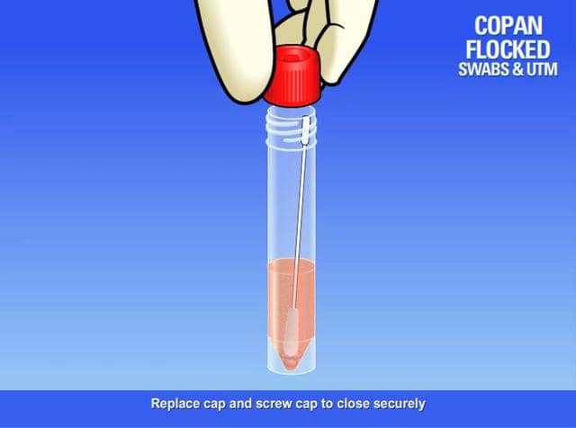 COPAN UTM and Flocked Swabs for Nasopharyngeal Sample Collection ...