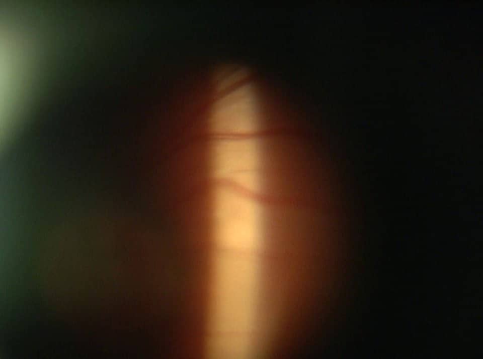 demonstration of pre-macula bursa vitreous eye floater on Vimeo