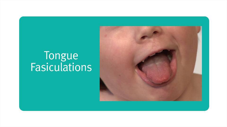 Tongue Fasiculations on Vimeo