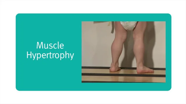 Muscle Hypertrophy Disease In Kids