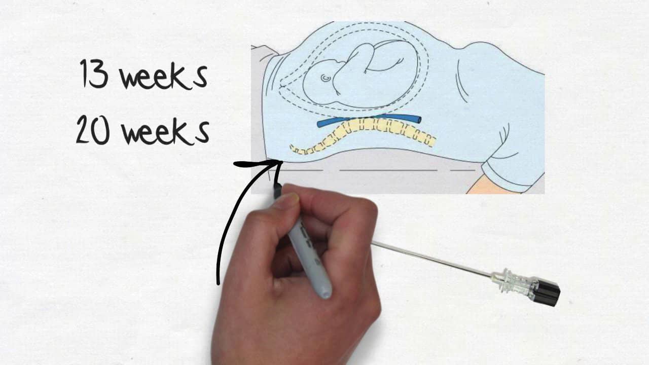 Aortocaval Compression - One Minute Anesthesia on Vimeo