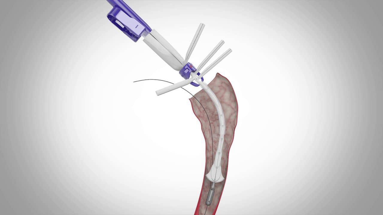 Thoraflex Hybrid Animation on Vimeo