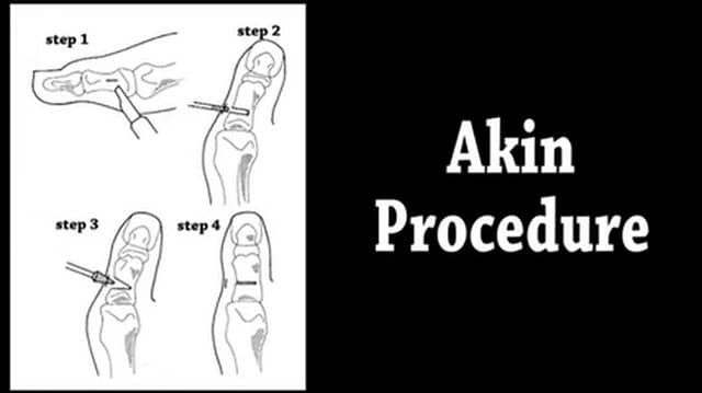 Akin Procedure - Minimally Invasive Surgery - Podiatrist, Dr. Jeff ...