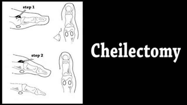 Cheilectomy - Minimally Invasive Surgery - Podiatrist, Dr. Jeff Adler ...