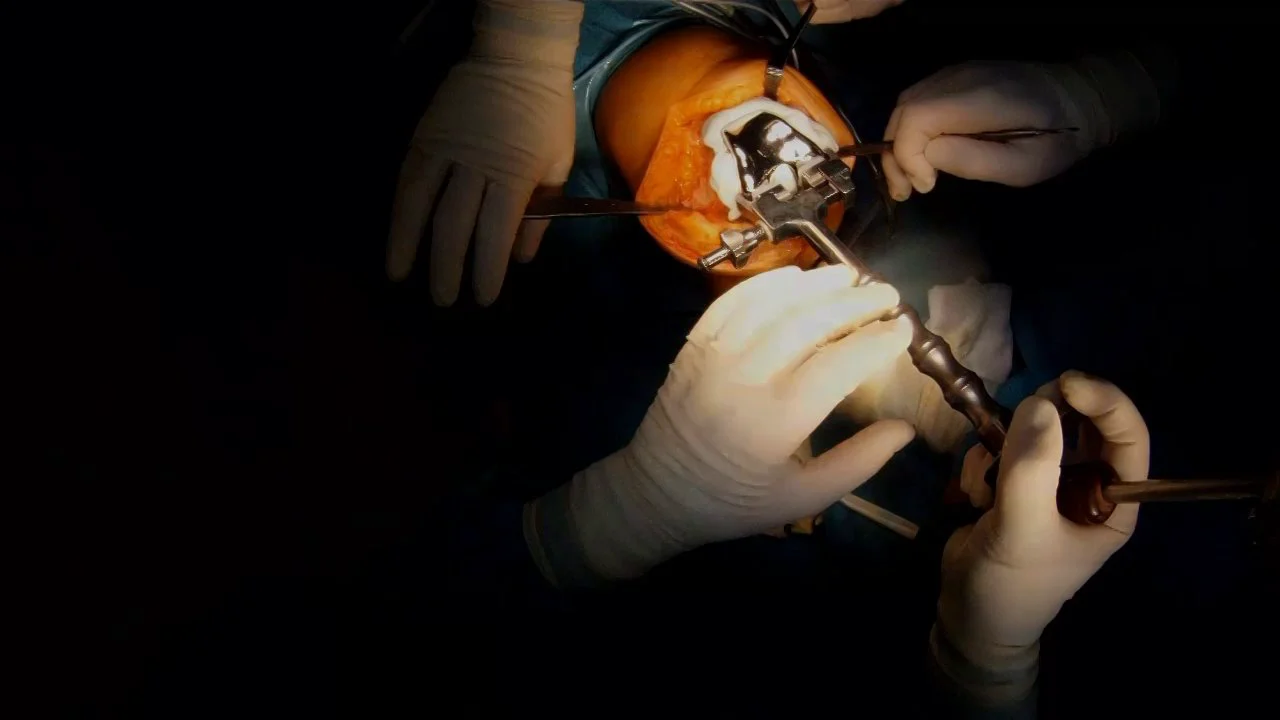 GoPro Surgery: Knee-TEP on Vimeo