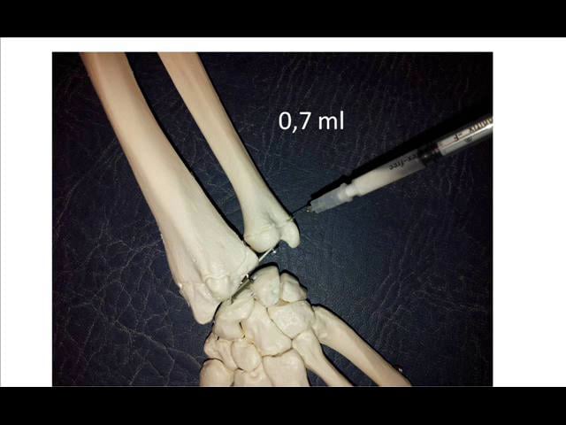 Injection into the DRUJ joint on Vimeo