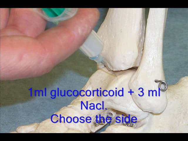 Injection into the tibiotalar joint on Vimeo