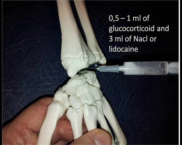 Radiocarpal joint injection on Vimeo