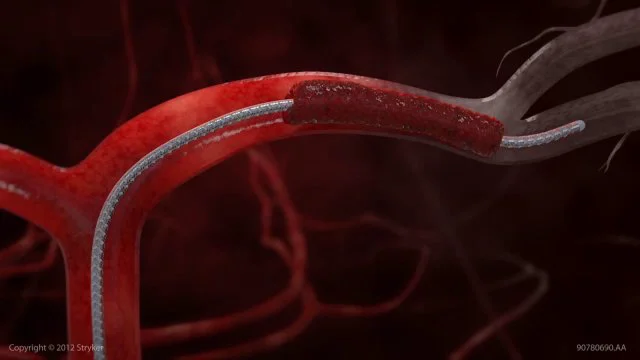 Stryker Trevo Pro Retrieval System