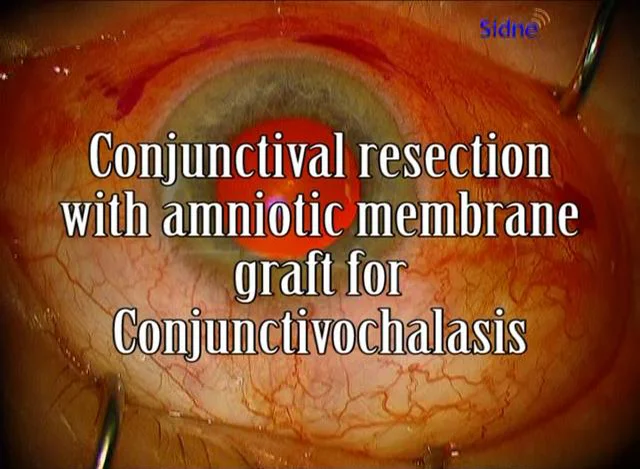 Conjunctival resection with amniotic membrane graft for conjunctivochalasis