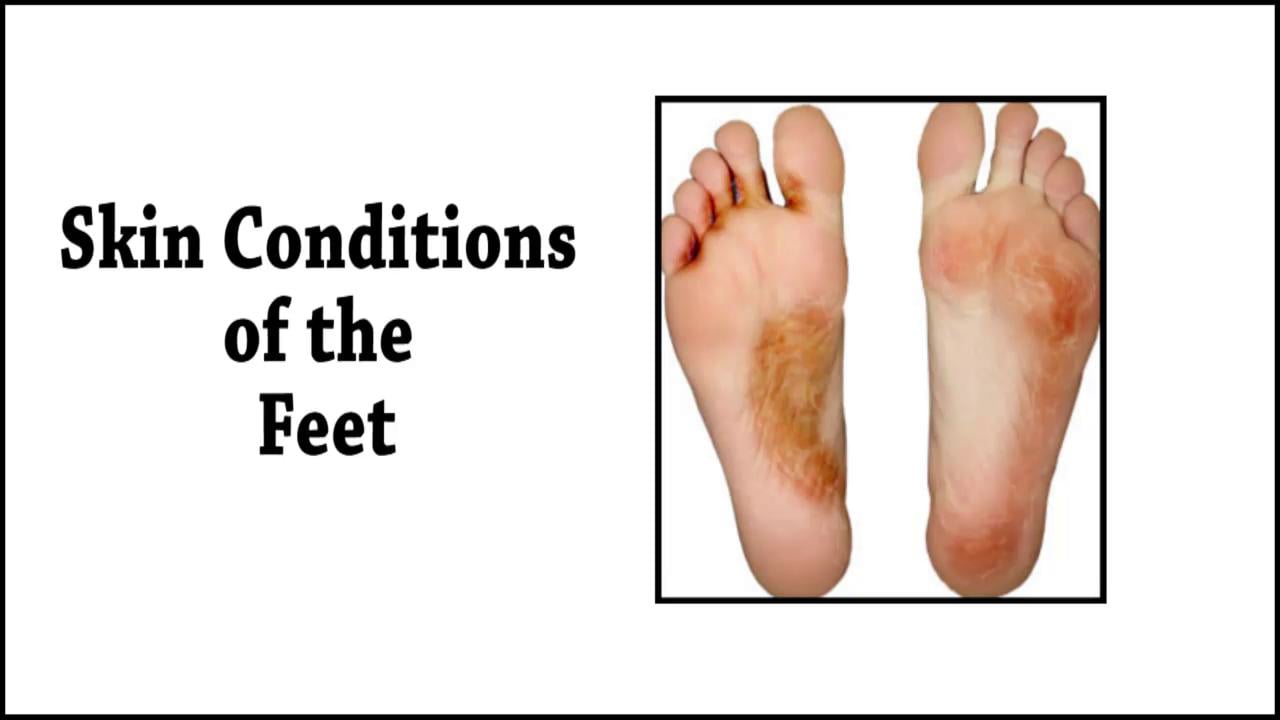 Feet Skin Conditions - Podiatrist in Littlestown, Hanover and ...