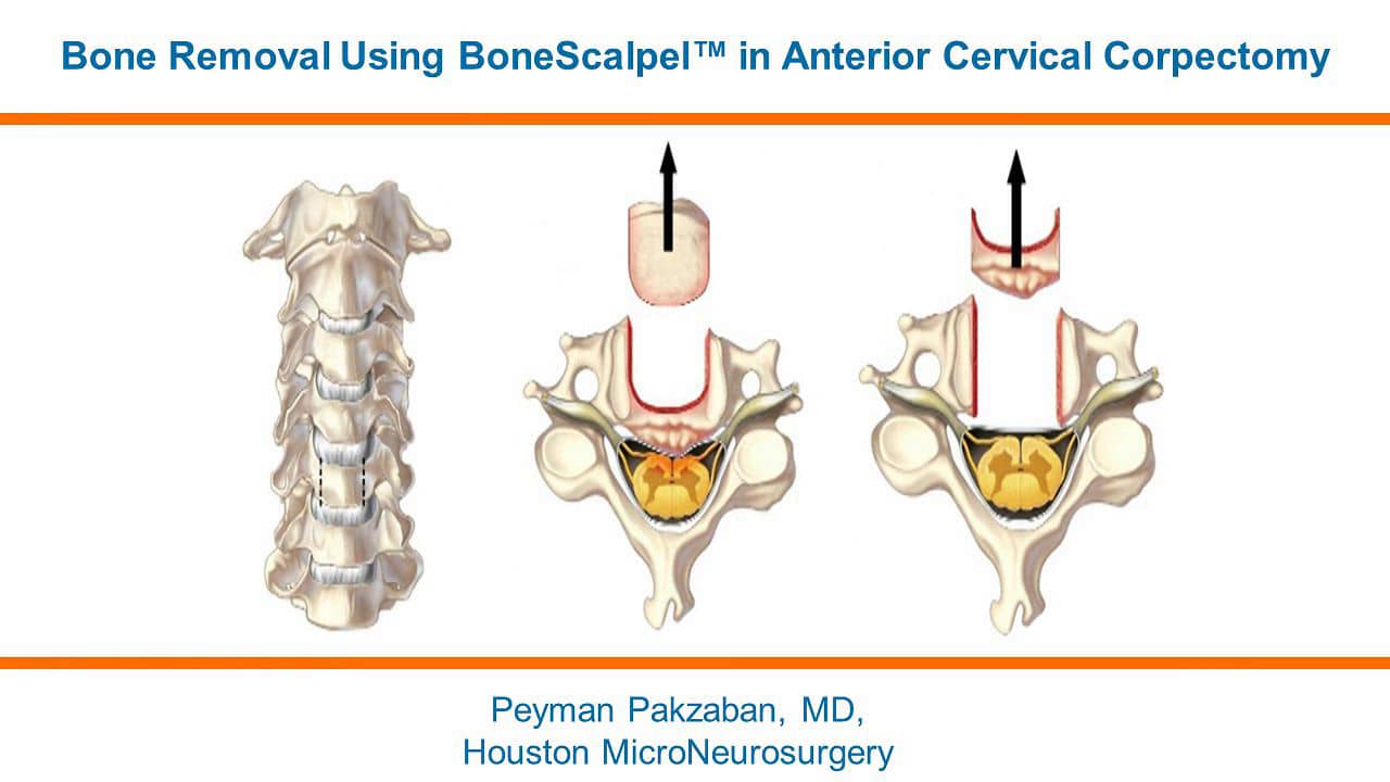 BoneScalpel | Dr. Pakzaban | Anterior Cervical Corpectomy on Vimeo