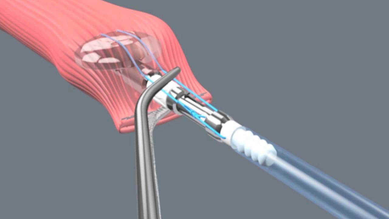 Use of a Circular Stapler in Laparoscopic Esophageal Surgery on Vimeo