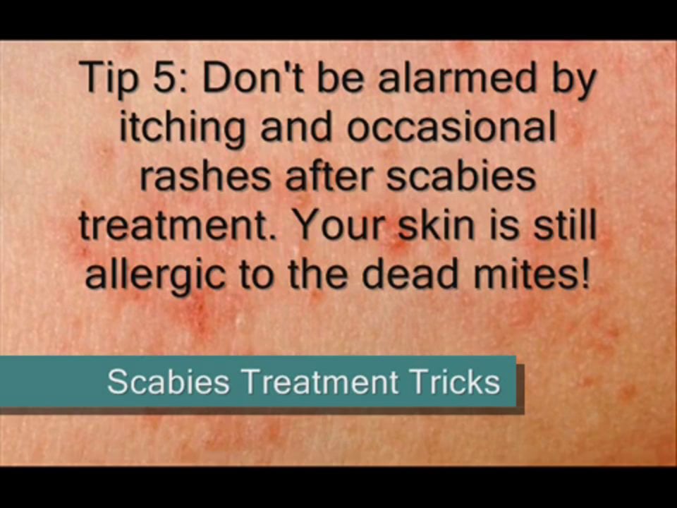 Scabies Home Treatment Tricks on Vimeo