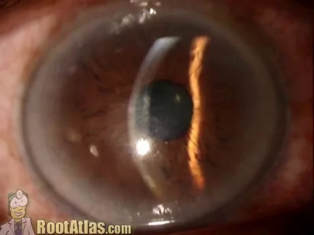 Corneal Guttata Retroillumination