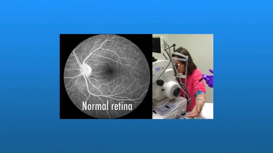 How Fluorescein Angiography Works on Vimeo