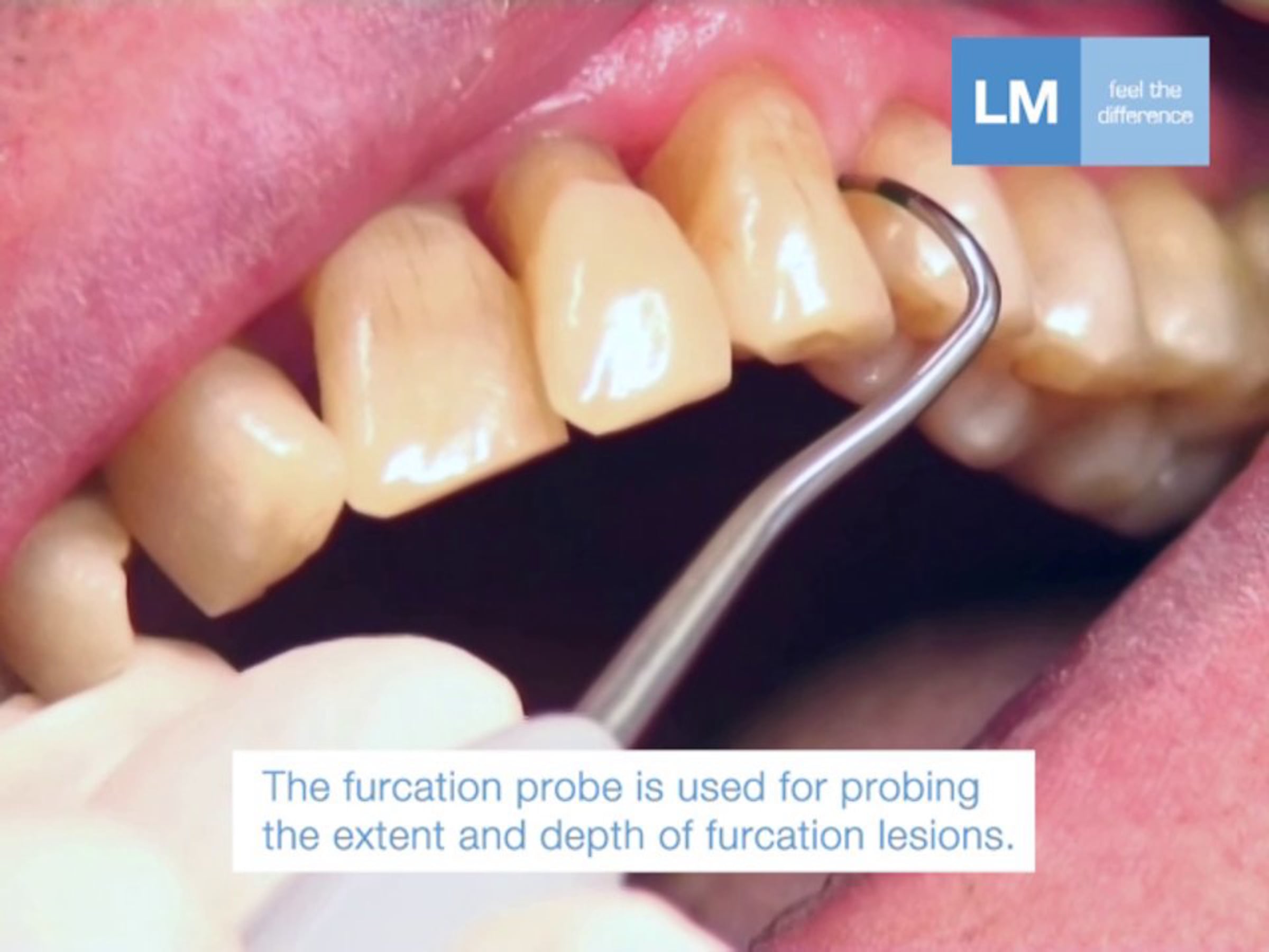 Clinical use of: Furcation probe