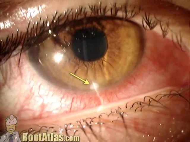 Marginal Ulcer Eye