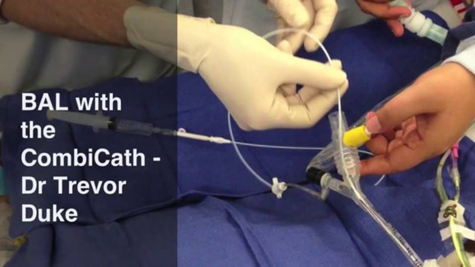 Bronchioalveolar Lavage with the CombiCath on Vimeo