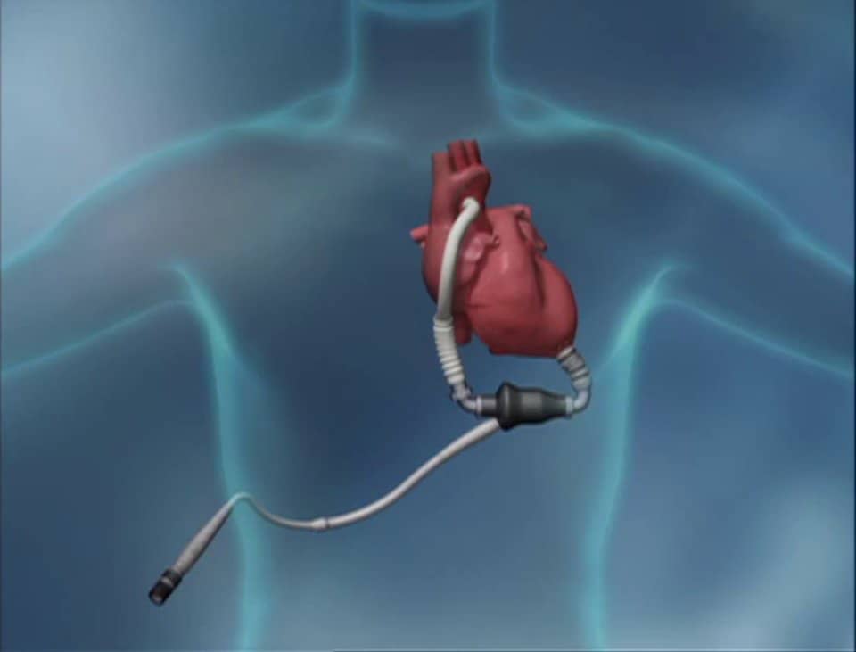 LVAD What First Responders Need to Know on Vimeo