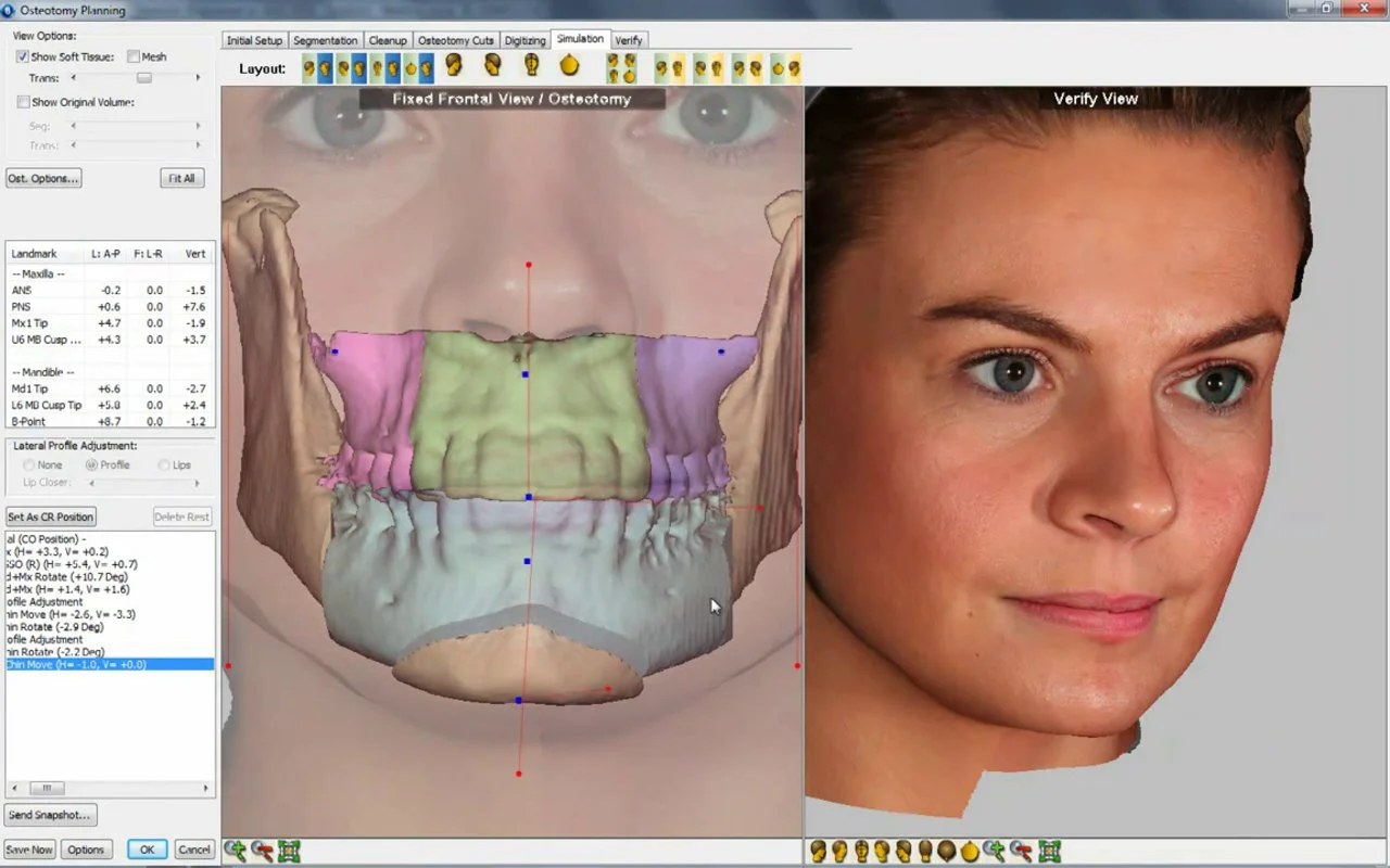 3D Visual Treatment Objective (VTO) Software Demo.mp4