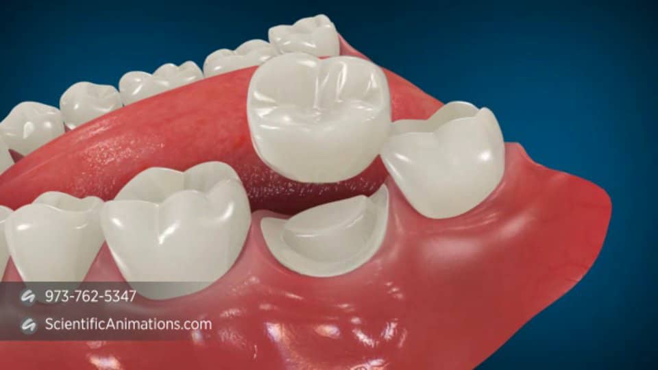Crown Lengthening Procedure - 3D Dental Animation on Vimeo