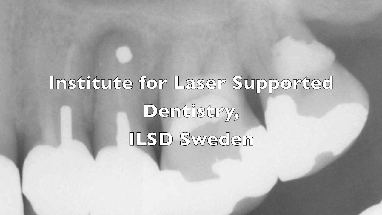 Er:YAG laser supported dentistry: Removal of granulation tissue 25 on Vimeo