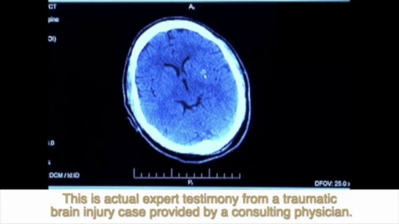 Brain Injury Axial CT Image - Axonal Shear Injury on Vimeo