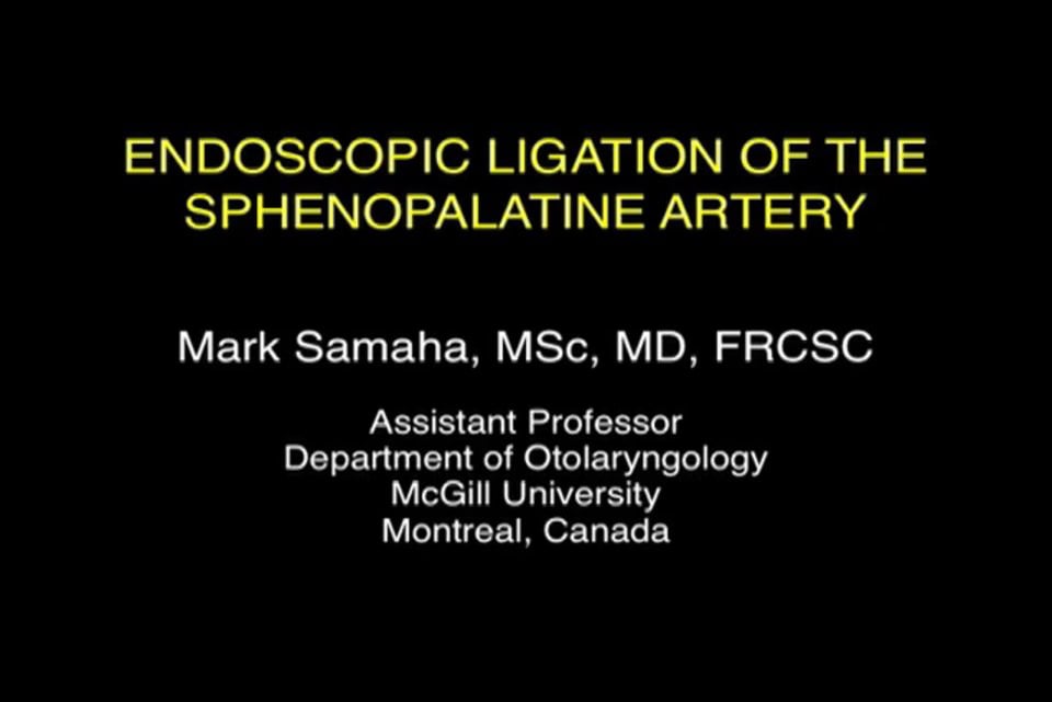 Endoscopic Ligation of the Sphenopalatine Artery on Vimeo