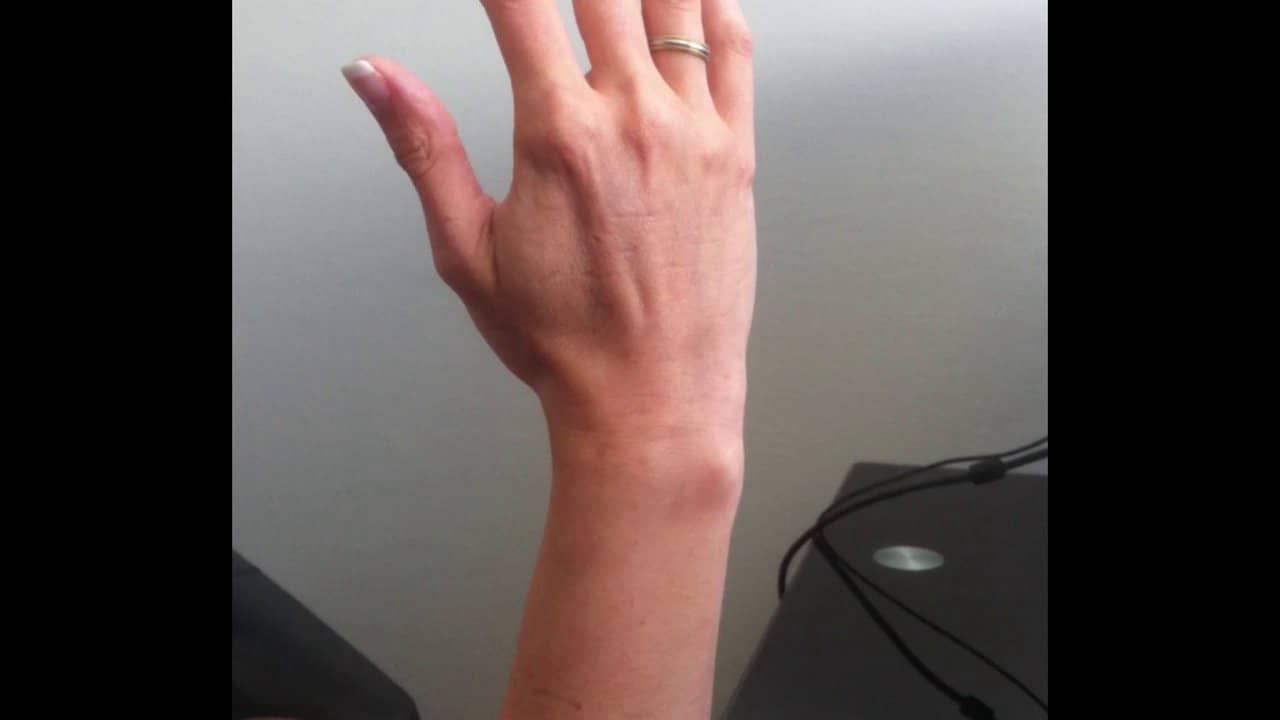 Résultat du brochage percutané d’une fracture du poignet on Vimeo